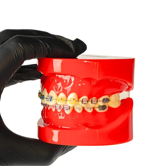 Buy Evodent Metal vs Ceramic Brackets Comparison Model for Patient ...