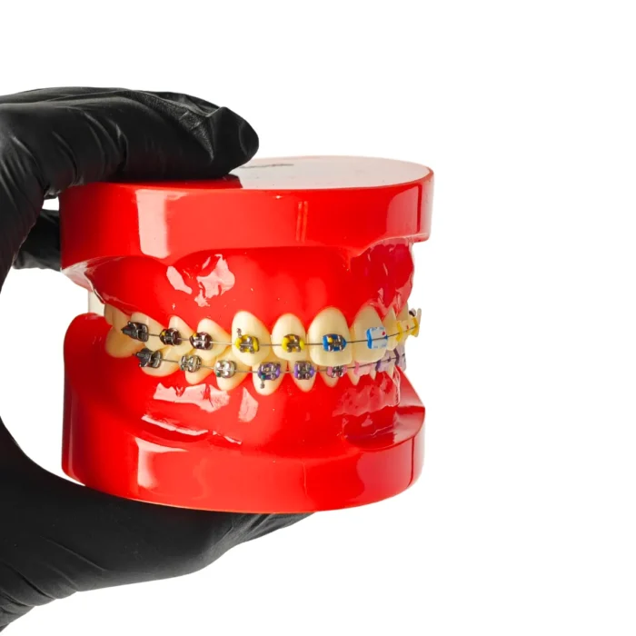 Buy Evodent Metal vs Ceramic Brackets Comparison Model for Patient ...