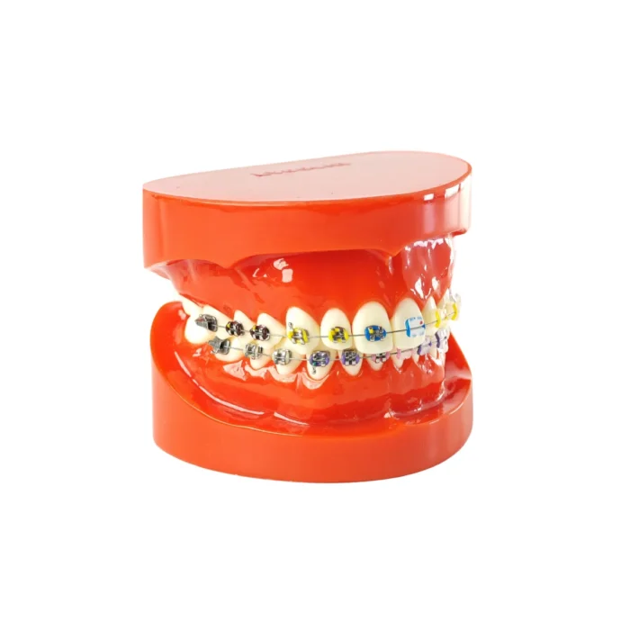 Buy Evodent Metal vs Ceramic Brackets Comparison Model for Patient ...